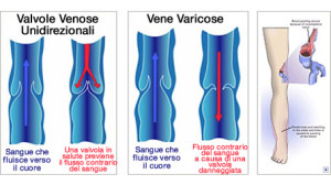 Prodotti naturali per combattere le vene varicose