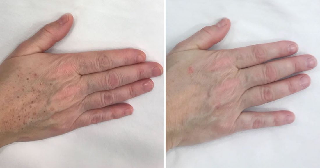 Come riparare le mani screpolate ed eliminare le macchie della pelle in ...