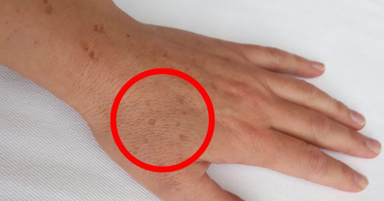 Come attenuare le macchie scure della pelle delle mani con rimedi naturali