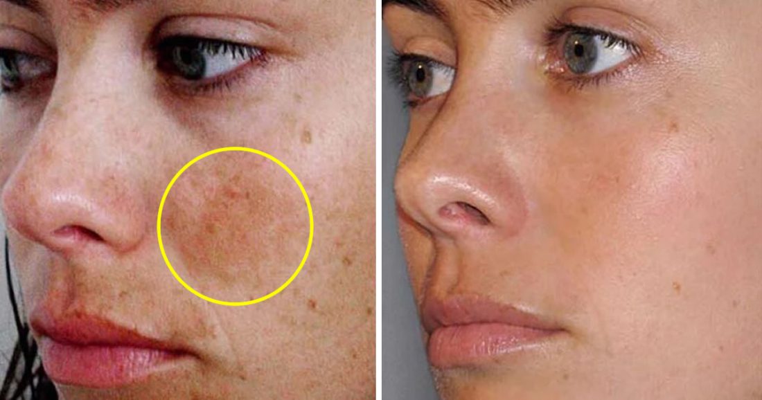 Come preparare una maschera che elimina le macchie della pelle da viso ...