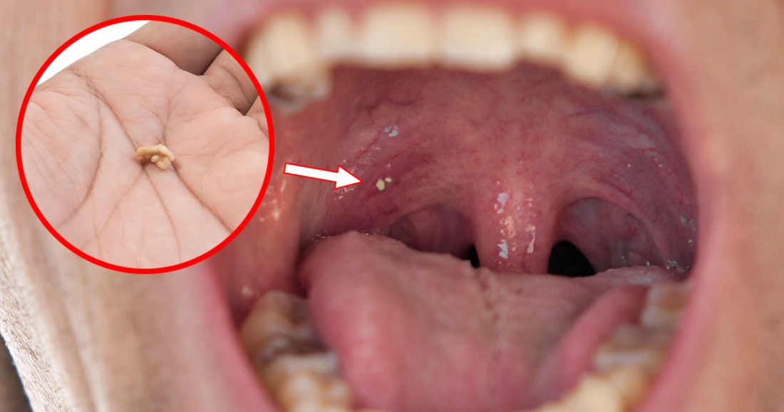 Come eliminare i "calcoli alle tonsille" per sbarazzarti dell'alito cattivo